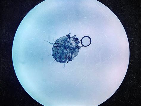 Crusted Scabies What Is It Symptoms Treatment And More