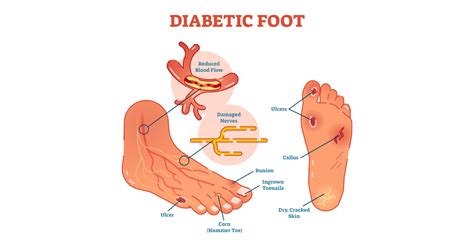 Diabetic Foot Care Conclusion At Kathy Foley Blog