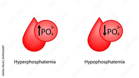 Hyperphosphatemia High Plasma Phosphate Level And Hypophosphatemia Low Plasma Phosphate Level