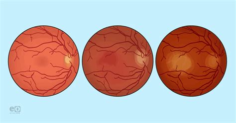 What Macular Degeneration To Geographic Atrophy Progression Really Looks Like