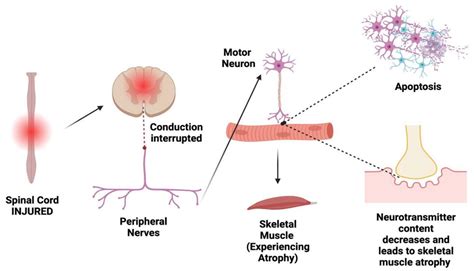 Upper And Lower Motor Neuron Lesion Nerve Block Upper And Lower Motor Neuron Lesion Nerve Block