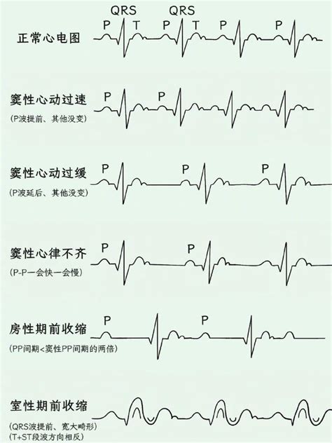 终于有人把心电图怎么看懂讲清楚了 （转）心电图新浪新闻