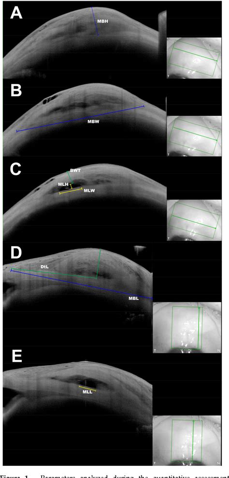Figure 1 From Comparison Of Bleb Morphology Following Preserflo® Microshunt And Trabeculectomy
