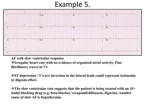 Atrial Fib And Flutter Pptx