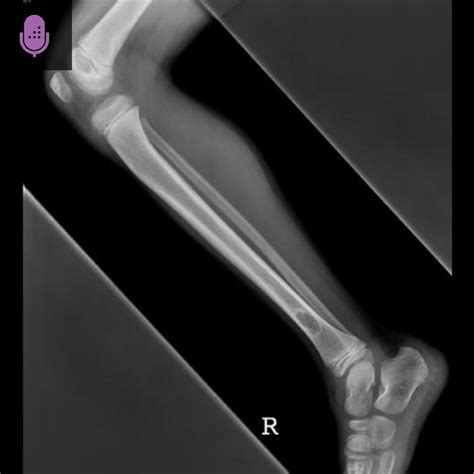 Orthobullets Non Ossifying Fibromas Are Benign