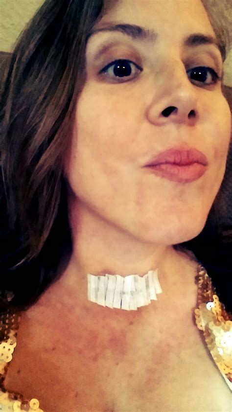 Xx Victoria Post Surgery Thyroid Removal Post Op Recovery Days Cancer Free