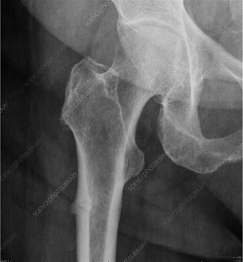 Bisphosphonate Femur Fracture X Ray Stock Image C039 3255 Science Photo Library