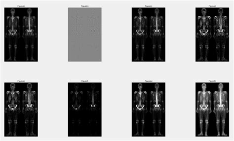 基于matlab数字图像处理之x射线图像的锐化和边缘检测滤波器 索炜达猿创 基于matlab数字图像处理之x射线图像的锐化和边缘检测滤波器 索炜达猿创
