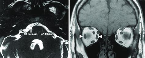 Axial Mr 3d Fiesta Image A Showing Expected Location Of Absent