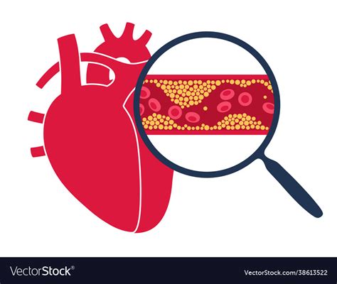 Cholesterol Heart Disease Royalty Free Vector Image