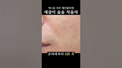 여드름흉터치료 남자여드름흉터 볼여드름흉터 아이스픽흉터 박스카흉터 부산새살침 새살침후기 흉터읽어주는한의사 Shorts Youtube
