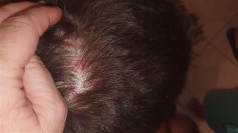 How To Get Rid From Scalp Folliculitis I Fight 6 Months Now I Use Ketoconazole Shampoo And