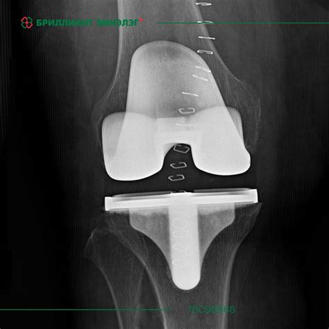 📌Өвдөгний үений мэс заслуудыг Эрүүл мэндийн даатгалын хөнгөлөлттэй үнээр хийж байна Остеоартрит