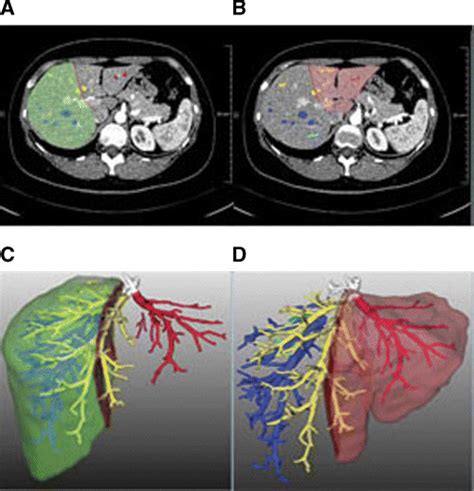A D Donor Virtual Hepatectomy ‘carving Technique 2 D Ct 3 D Download Scientific Diagram