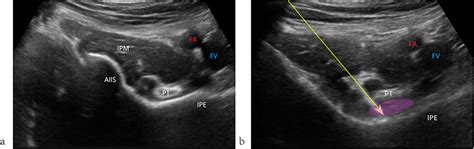 Comparison Of Peng Block With Lfcn And Ficb In Ahs Jpr Comparison Of Peng Block With Lfcn And Ficb In Ahs Jpr
