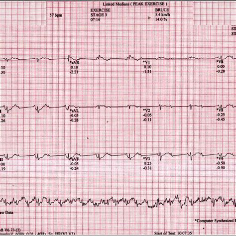 Electrocardiogram At Stage Of Exercise Treadmill Test Download Scientific Diagram