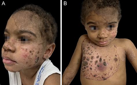 Case For Diagnosis Disseminated Erythematous And Scaly Plaques