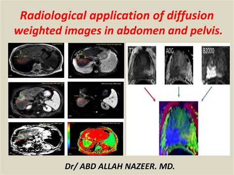 Presentation1 Radiological Application Of Diffusion Weighted Images In Abdome And Pelvic