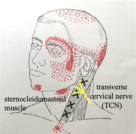 Sternocleidomastoid Trigger Points Sternocleidomastoid Trigger Points