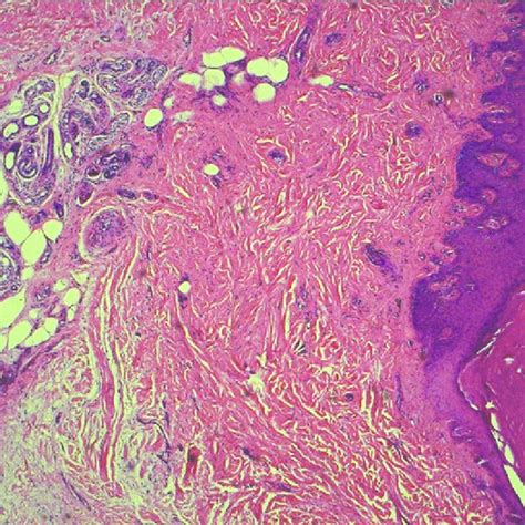 Pdf A Cases Series Of Piezogenic Pedal Papules