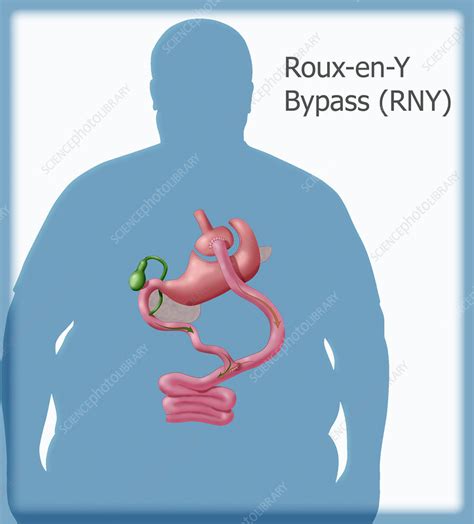 Roux En Y Gastric Bypass Surgery Stock Image C0432625 Science