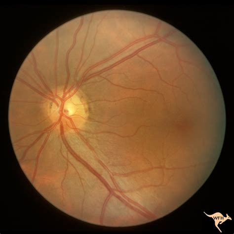 Segmental Atrophy Altitudinal Eccles Health Sciences Library J