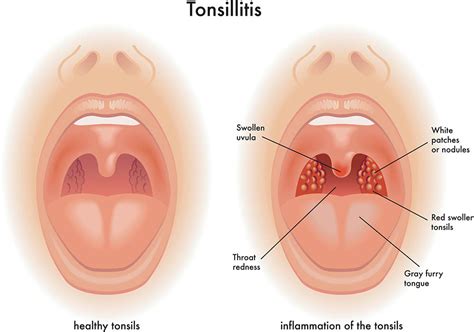 Tonsils And Adenoids Drdugad