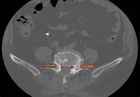 C Lateral Recess Height On Postoperative Ct Scan Download Scientific Diagram