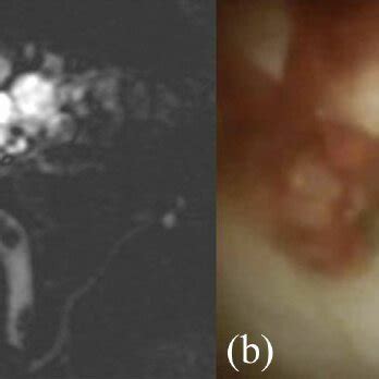 Magnetic Resonance Cholangiography Shows A Filling Defect Of The Left Download Scientific