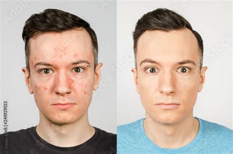 Two Guys Before After Left Guy With Acne Red Spots Problem Skin Right Guy With Healthy Skin