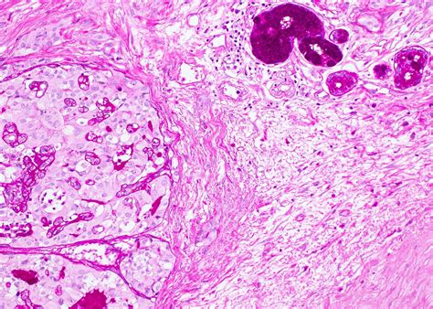 Pathology Outlines Pas Periodic Acid Schiff