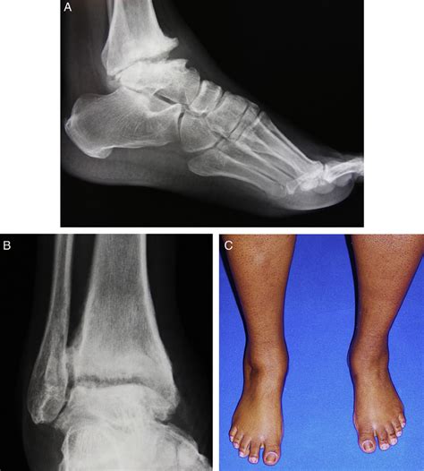 A At 7 Years Postoperative The Patient Has A Functional Download Scientific Diagram