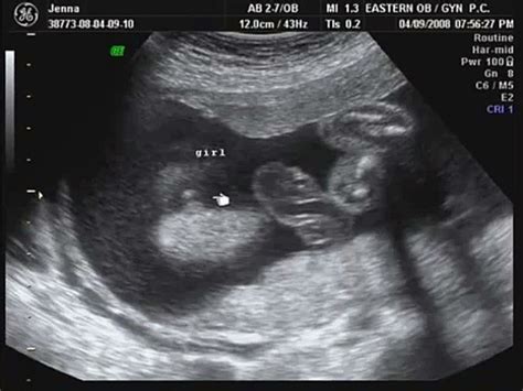 8 Month Ultrasound Hiccups Pregnancy