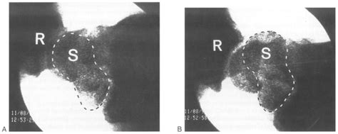 Fluoroscopic Lateral Views Of A Scaphoid Shift Test Performed On A Download Scientific Diagram
