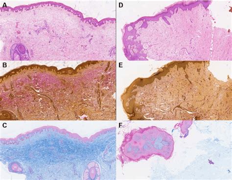 Pretibial Myxedema Pathology