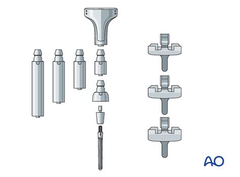 Proximal Tibia Replacement For Fracture Around A Loose Tibial Component With Good Bone Stock