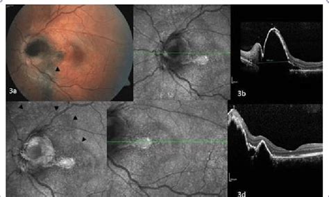 Features At Follow Up After Intravitreal Ranibizumab A Clinical Download Scientific Diagram