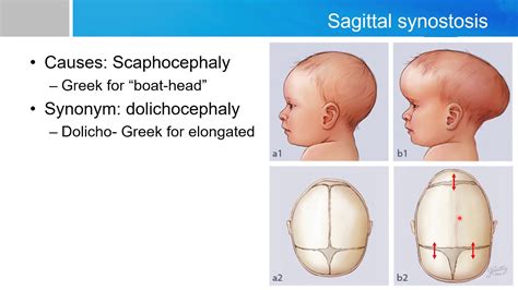 Neurosurgery Written Board Crash Course Craniosynostosis Part1 Youtube