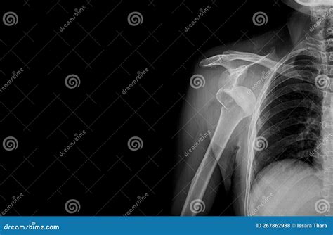 Fracture Proximal Humerus Arm In Osteopenia Patient Elderly Broken