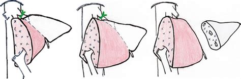 Schematic Representation Of Two Stage Hepatectomy With Preservation Of