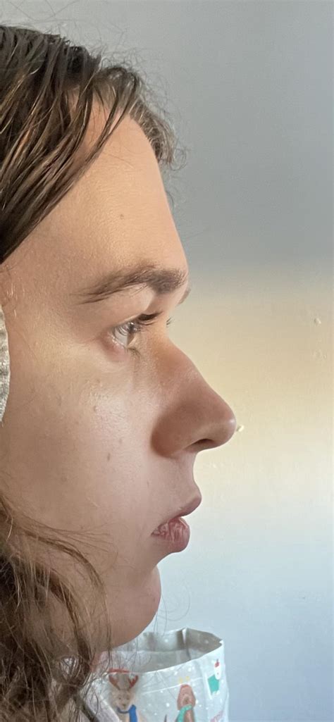 Biggest Brow Ridge Ever R Transgender Surgeries