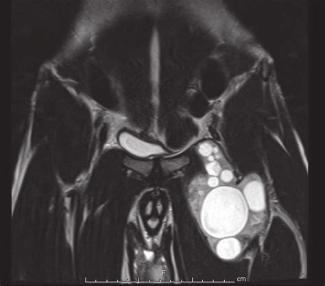 Magnetic Resonance Imaging Of Hydatid Cyst Of The Patient Located In
