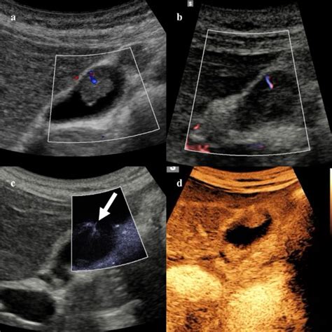 49 Year Old Woman With Incidentally Detected 1 2 Cm Gallbladder Polyp Download Scientific
