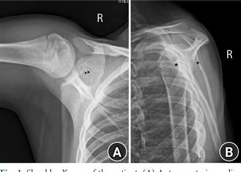 Figure 1 From Normal Ossification Of The Glenoid Mimicking A Glenoid Fracture In An Adolescent