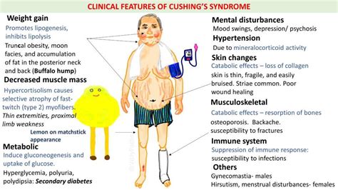 Cushings Syndrome Pathology Made Simple