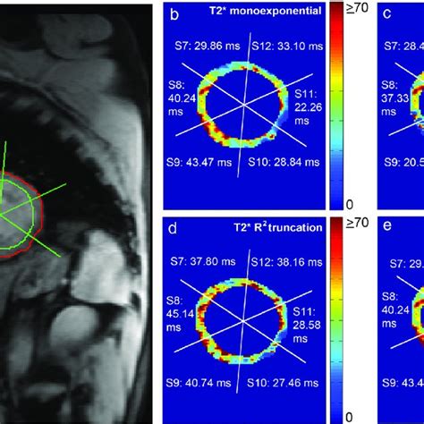 Bulls Eye Plots Showing Global Myocardium Using Aha 16 Segments Model