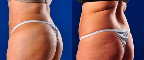 Long Term Recovery And Results What You Need To Know About Bbl Surgery