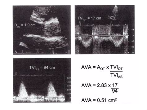 Hemodynamic Assessment By Echocardiography Ppt