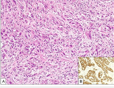Sarcomatoid Carcinoma Stained With Hematoxylin And Eosin The Tumor Is Download Scientific