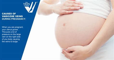 Varicose Veins During Pregnancy The Complete Guide